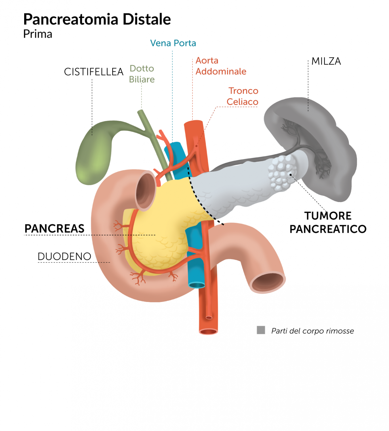 Pancreasectomia-distale-prima-intervento - Codice Viola - Associazione ...